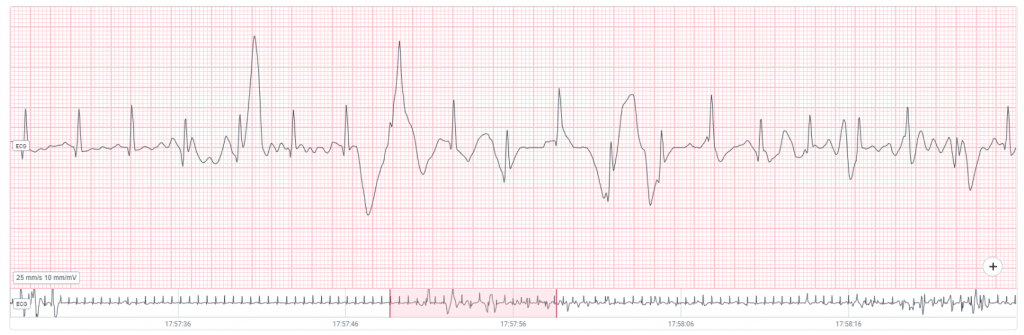 How does low quality signal affect ECG analysis and practical tips to ...