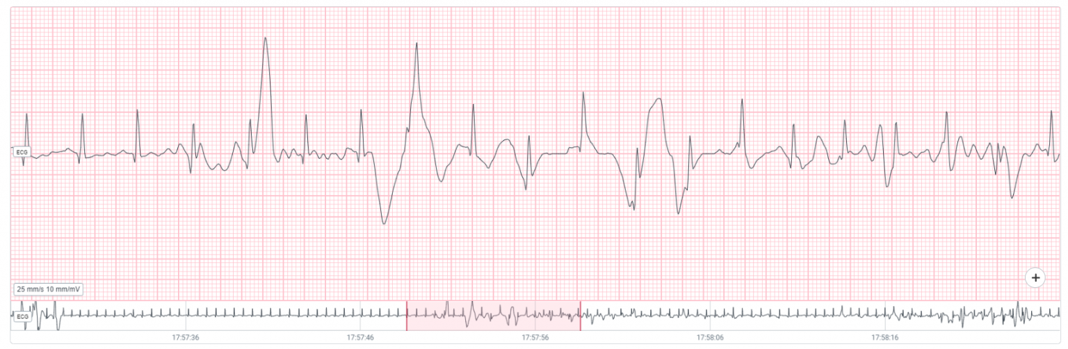 How does low quality signal affect ECG analysis and practical tips to ...