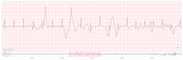 How does low quality signal affect ECG analysis and practical tips to ...