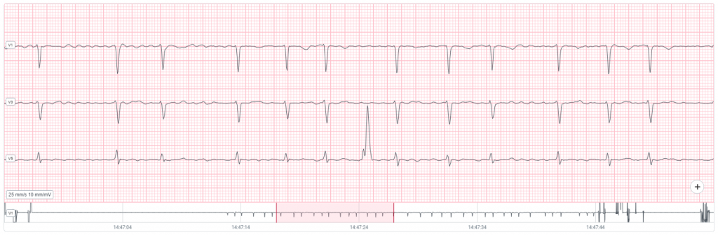 How does low quality signal affect ECG analysis and practical tips to ... How does low quality signal affect ECG analysis and practical tips to ...