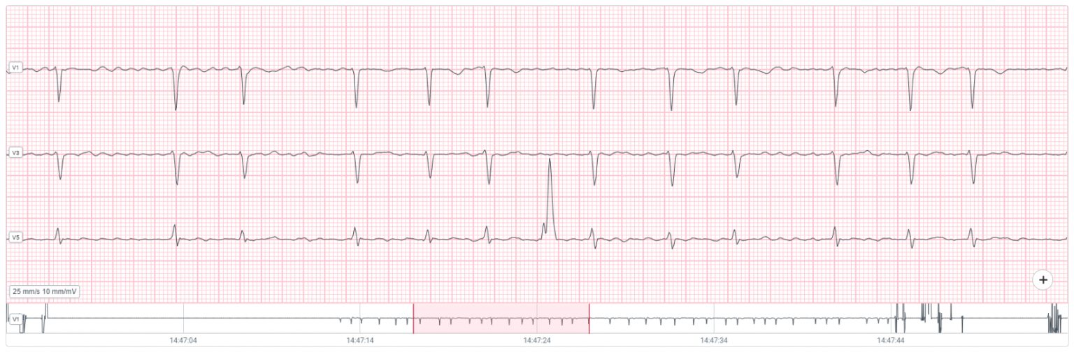 How does low quality signal affect ECG analysis and practical tips to ...