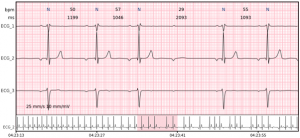 Cardiomatics guide: Analyzing arrhythmias made easy