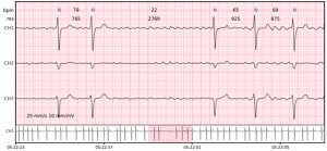 Cardiomatics guide: Analyzing arrhythmias made easy