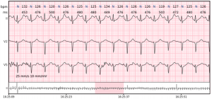 Cardiomatics guide: Analyzing arrhythmias made easy