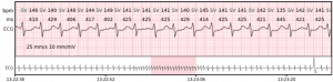 Cardiomatics guide: Analyzing arrhythmias made easy