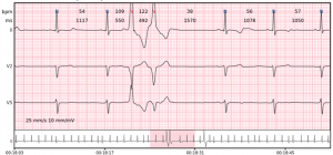 Przewodnik Cardiomatics: Łatwa analiza arytmii - Cardiomatics