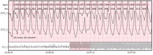 Cardiomatics guide: Analyzing arrhythmias made easy