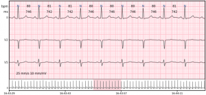 Cardiomatics guide: Analyzing arrhythmias made easy